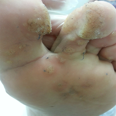 Plantar Warts – Family Wellness Footcare and Orthotics